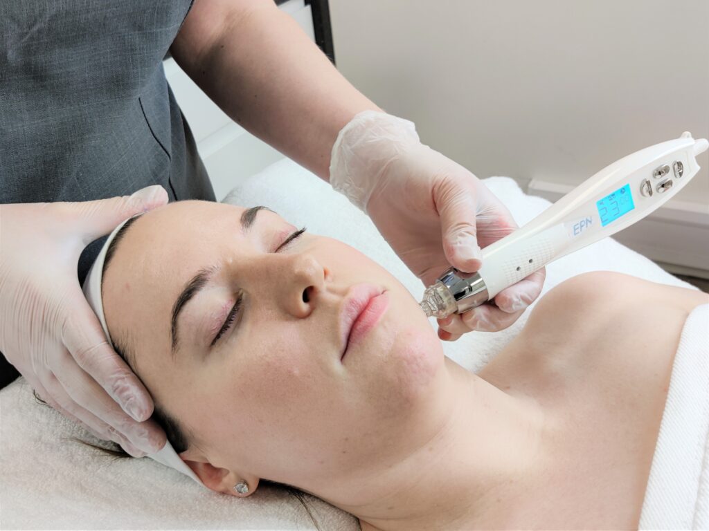 Micro Needling - Collagen Induction Therapy ⋆ Sophia Wyatt