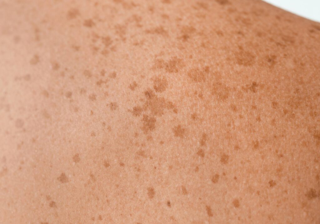 Age Spots, Liver Spots, Sun Spots, Freckles & Pigmentation ⋆ Sophia Wyatt